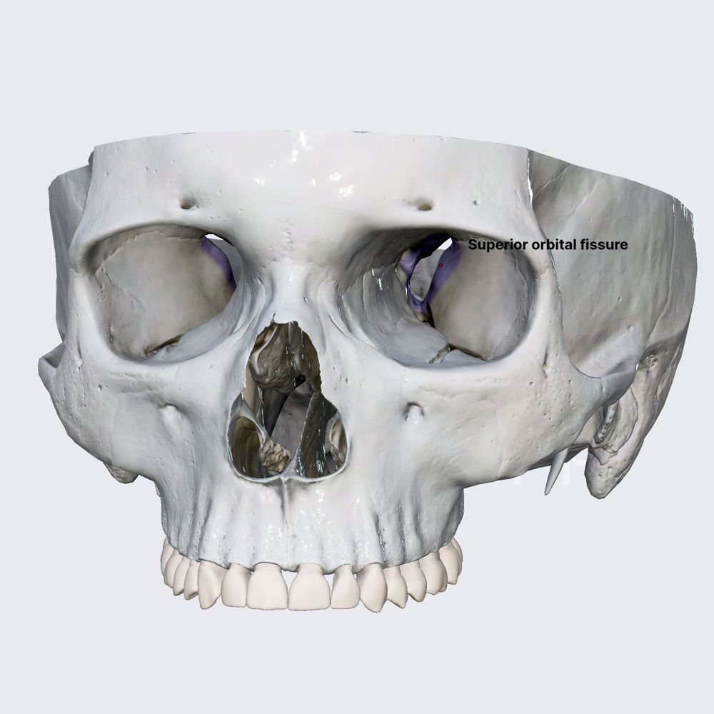 Infraorbital Fissure