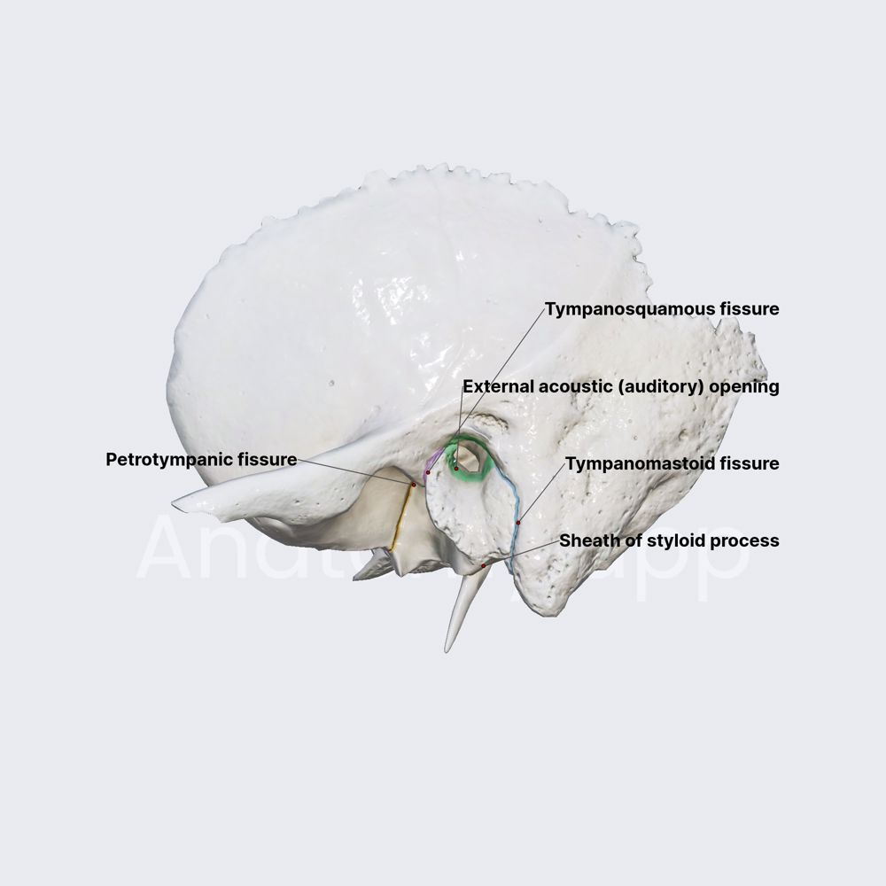 Note Petrotympanic Fissure Complex, Comminuted Temporal Bone Fracture