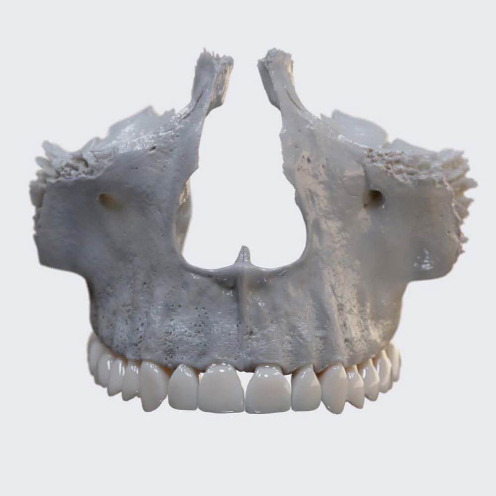 Maxilla Bone